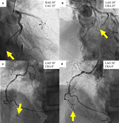 Coronary Angiography And Coil Embolization Left Coronary Angiography