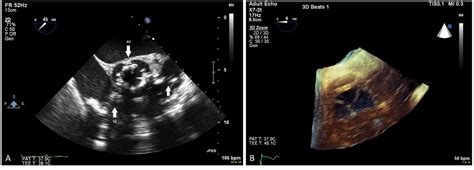 Multimodality Imaging In Carcinoid Heart Disease Open Heart
