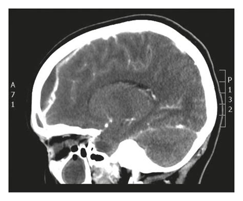 Sagittal Brain Ct Scan Showing A Subdural Empyema Download
