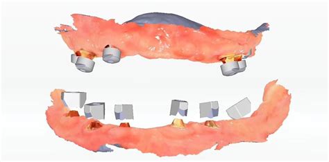 Aoralscan Elite OsseoDent