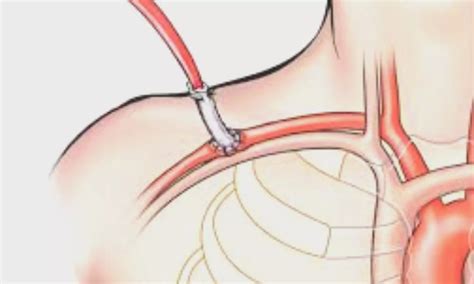 Ketorolac Reduces Icu Stay And Bleeding In Aortic Dissection Patients