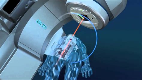 Edge With Hyperarc New Age In Intracranial Frameless Stereotactic Radiosurgery Srs