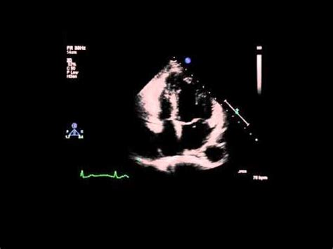 Transthoracic Echocardiographic Images YouTube