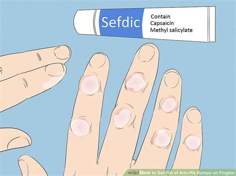12 Ways To Get Rid Of Arthritis Bumps On Fingers Wikihow