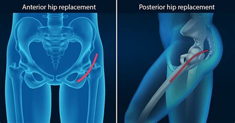 Posterior Vs Anterior Hip Replacement Doctorvisit