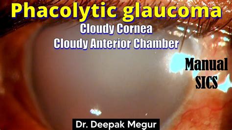 Phacolytic Glaucoma