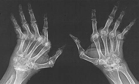 Rheumatoid Arthritis Ra Conway Homer Pc