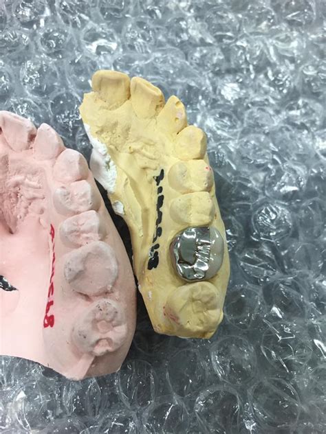 ตัวอย่างฟันปลอมแบบติดแน่น ครอบฟัน คลินิกฟันหมอวรงค์ Facebook