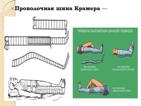 Шины для транспортной иммобилизации конечностей: - презентация онлайн