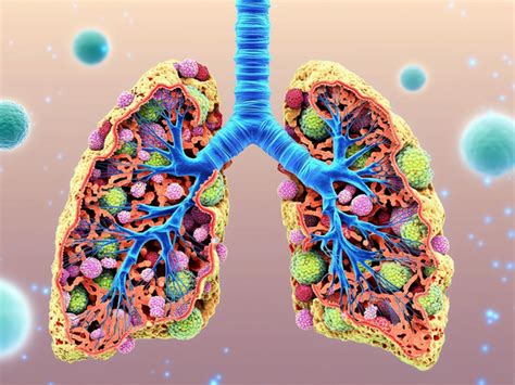 小细胞肺癌一线化疗方案用药及周期 小细胞肺癌 肺癌 肿瘤疾病大全癌症肿瘤科普知识 有来医生 小细胞肺癌一线化疗方案用药及周期 小细胞肺癌 肺癌 肿瘤疾病大全癌症肿瘤科普知识 有来医生