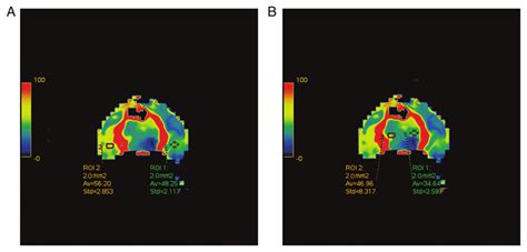 Measurements Of Rcbf In The Temporal Lobe And Basal Ganglia From The