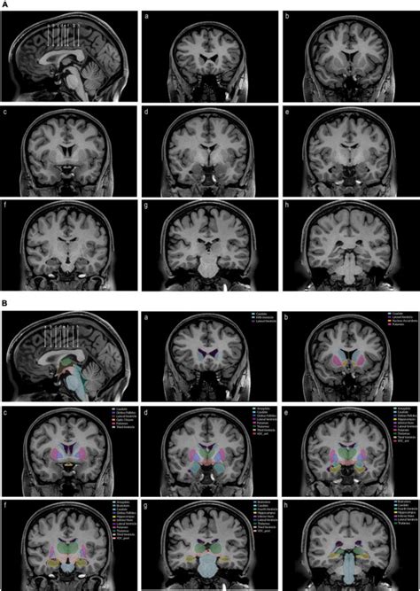 Anatomically Curated Segmentation Of Human Subcortical Structures In High Resolution Magnetic