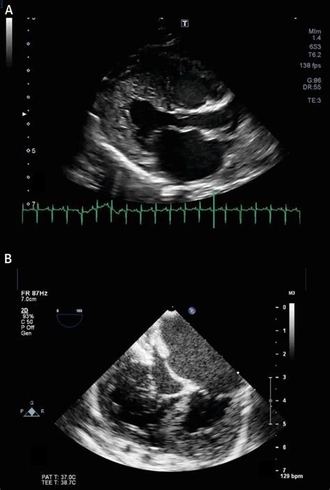 Excessive Trabeculation Of The Left Ventricle Jacc Cardiovascular Imaging Expert Panel Paper Pmc