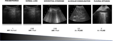 Pleuropulmonary And Diaphragmatic Ultrasound In Intensive Care Medicine