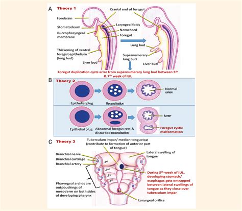 What Is A Foregut Duplication Cyst At Jack Black Blog