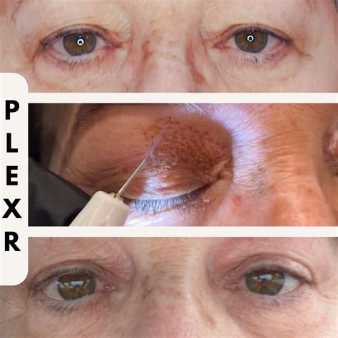 Plexr Skin Tightening Smooth Wrinkles And Rejuvenate Eyes No Surgery