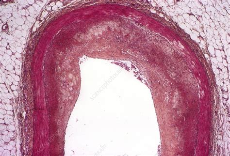 Atherosclerosis Light Micrograph Stock Image C023 6012 Science Photo Library