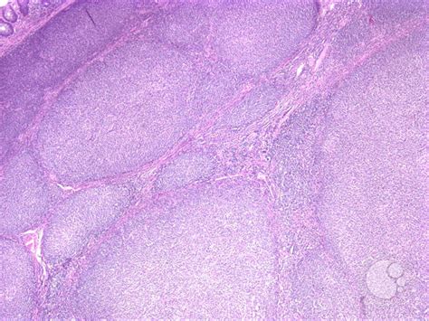 Follicular Lymphoma Grade 1 3 In A Hepatic Flexure Polyp 3