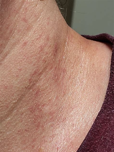 Its Not Eczema Its Scabies How I Kicked Crusted Scabies Ass 💪 R
