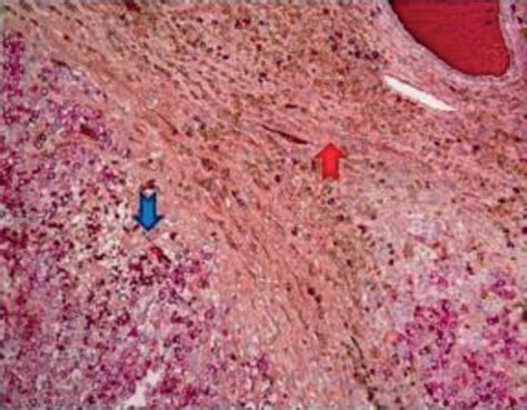 A Immunohistochemical Stain For Lambda Positive In The Pbl Blue