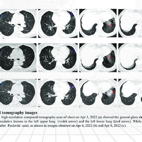 Chest Computed Tomography Images After Admission The High Resolution