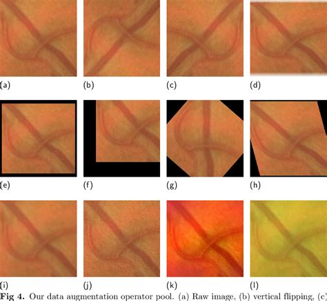 Figure 4 From Automated Grading System Of Retinal Arterio Venous