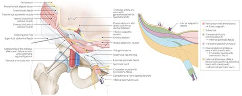 Direct Inguinal Hernia Netter
