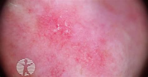 Actinic Keratoses Affecting The Face Image