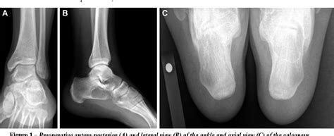 Figure 1 From Unicameral Bone Cyst Of The Calcaneus Minimally