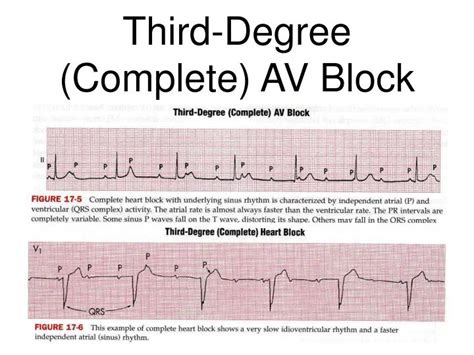 Complete Atrioventricular Av Block