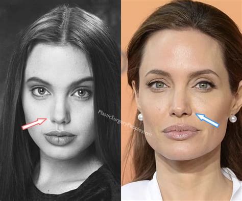 Is Plastic Surgery Angelina Jolies Beauty Secret