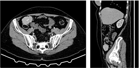 42 × 46 × 46 Cm Solid Lesion Located In The Antimesenteric Border Of