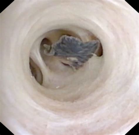 Shocking Video Reveals Squirming Worms Invaded Mans Abdomen