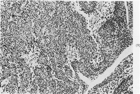 Section Through One Of The Papillary Fronds Of A Well Differentiated