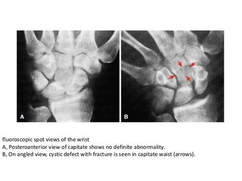 Carpal Bone Fractures