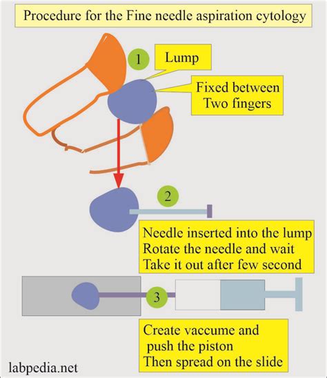 Fine Needle Aspiration Cytology Fnac Fine Needle Aspiration Biopsy