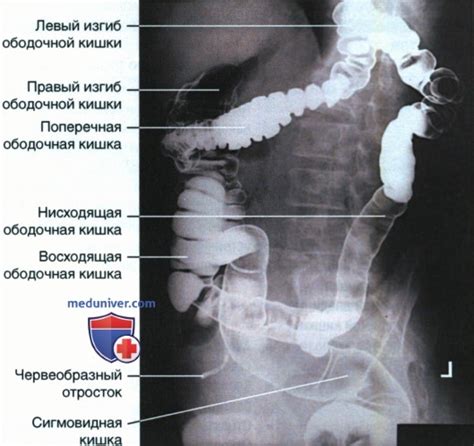 Укладка при рентгенограмме толстой кишки в левой передней косой проекции