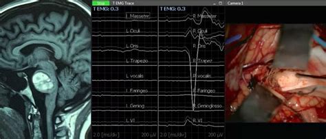 Multimodal Neurophysiologic Monitoring Used In A Brainstem Tumor Surgery Download Scientific