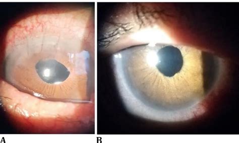 Figure 1 From Retropupillary Iris Fixated Versus Sutured Scleral Fixated Intraocular Lenses