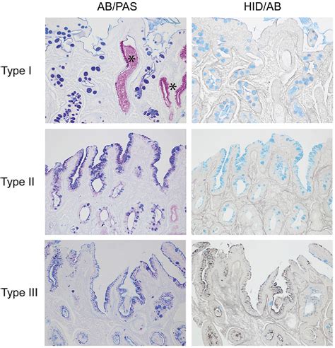 Figure 1 From Histologic Subtyping Of Gastric Intestinal Metaplasia