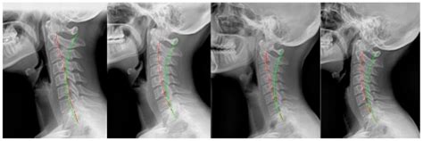 Case 6 Left Pre Treatment Middle Left Post Treatment Middle