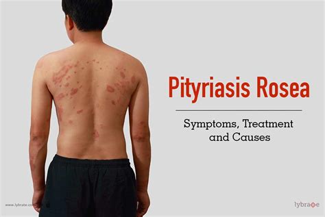 Pityriasis Rosea Get Facts On Symptoms Treatments And Causes Health