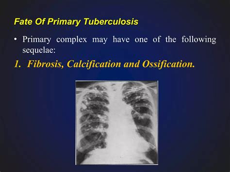 Tuberculosis Ppsx