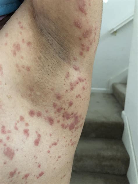 Day 5 In Between Permethrin Treatments R Scabies