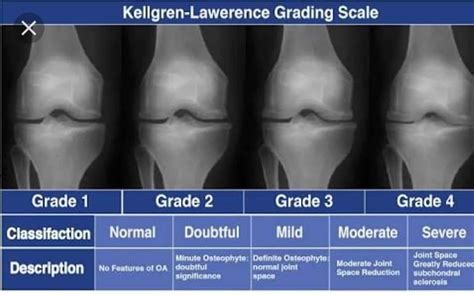 The Kellgren Lawrence Grading System Is Radiological Classification Of Knee Osteoarthritis It