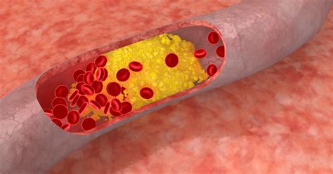 Check Up Risco Cardiovascular Posenato Diagnósticos