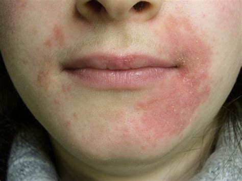 Contact Dermatitis Forehead