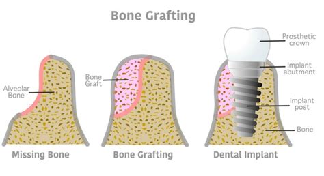 Dental Bone Grafts Parklane Dental