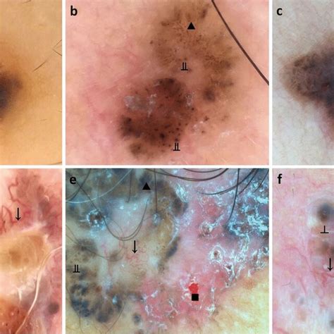 Comparisons Of Classic Basal Cell Carcinoma Bcc Dermoscopic Patterns