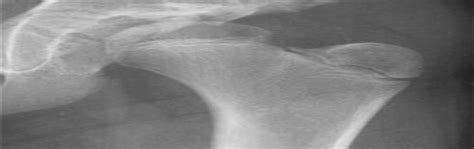 Reliability Of Bucholz And Ogden Classification For Osteonec